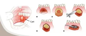 Jaw-Tumors-Cysts | Freedmans Health