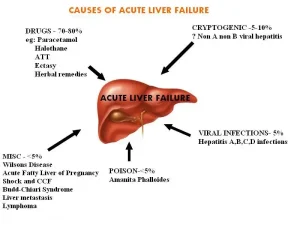 Acute Liver Failure | Freedmans Health